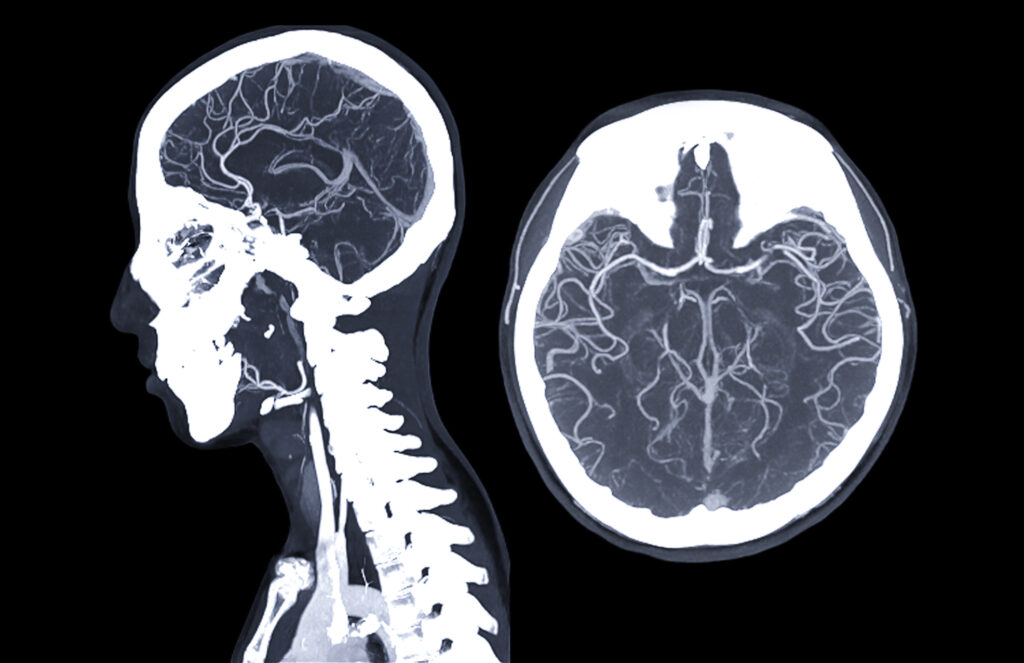 MR CLEAN-LATE results presented at the World Stroke Congress 2022 ...